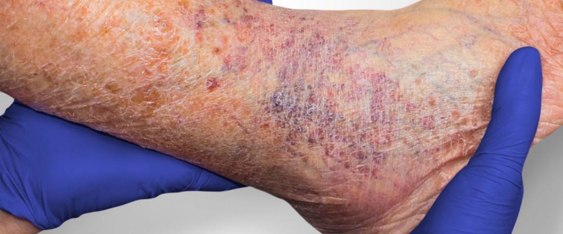 When Should I Seek Medical Attention For Skin Ulcer Symptoms