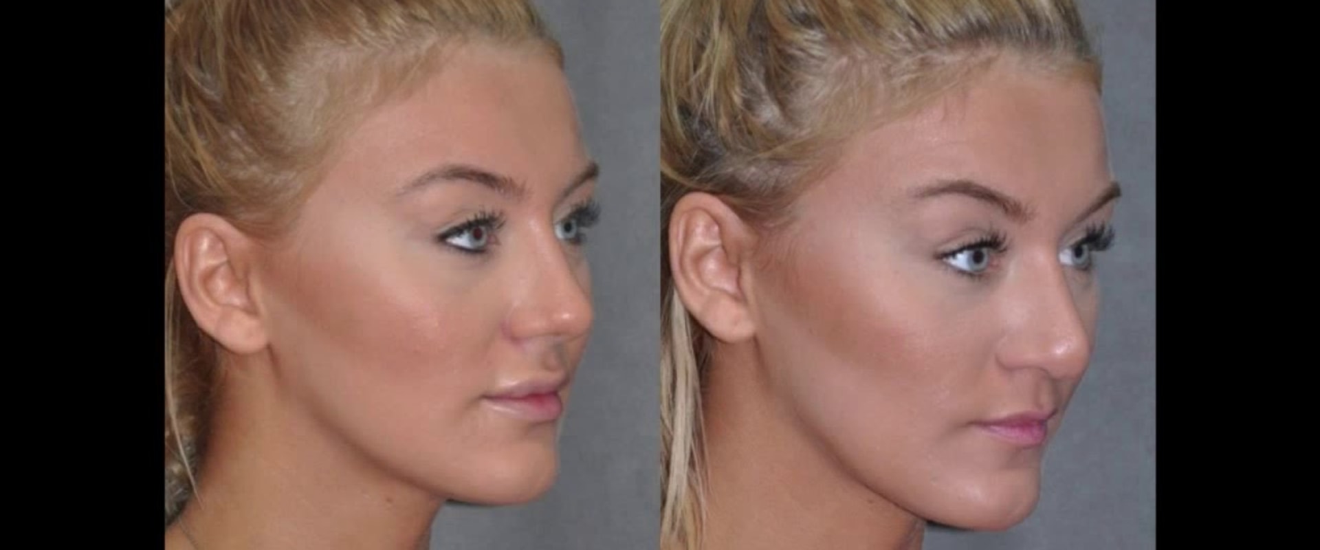 Who is the best closed rhinoplasty in beverly hills?